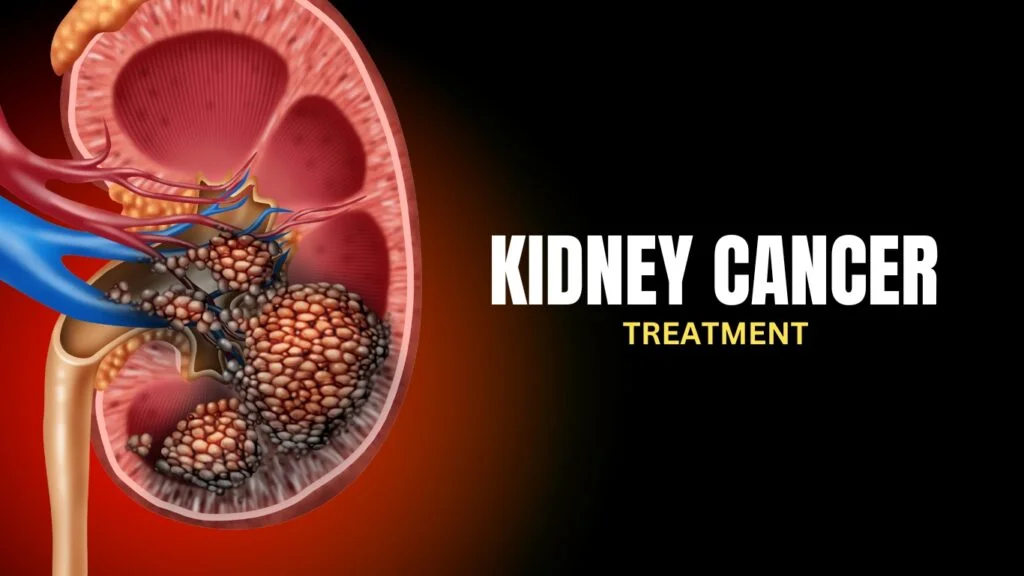 Kidney Cancer Treatment in Wisconsin